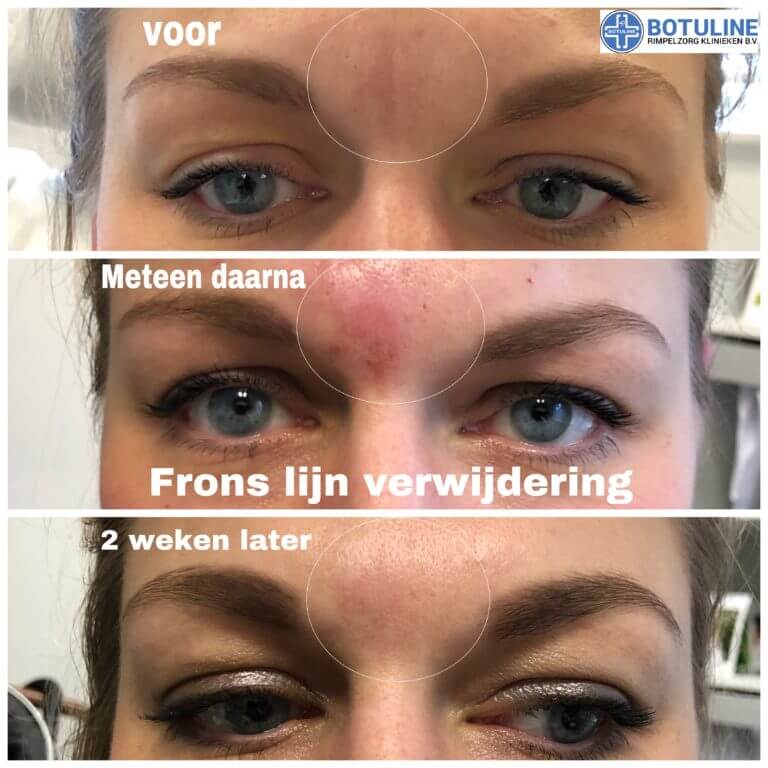 Fronsrimpel combinatie therapie - Rimpelzorg Klinieken